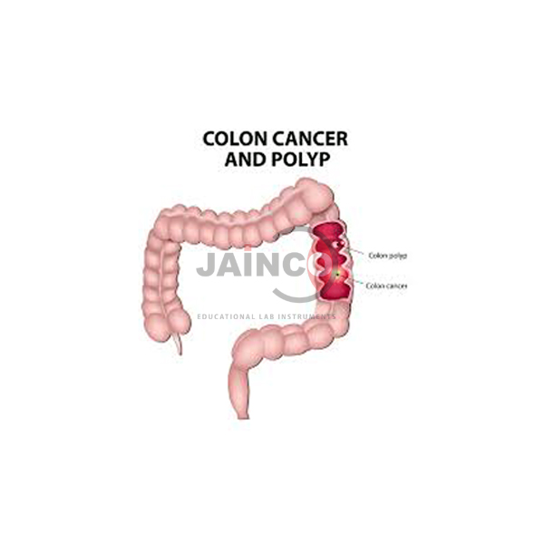 Colon Cancer and Polyp Model Manufacturers, Supplier & Exporters in ...